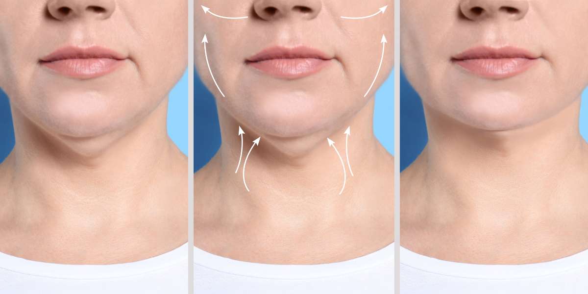 Lipopapada: Elimine A Gordura Submentoniana Sem Cirurgia - Cidade Viva